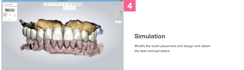 Digital Implant DIOnavi.